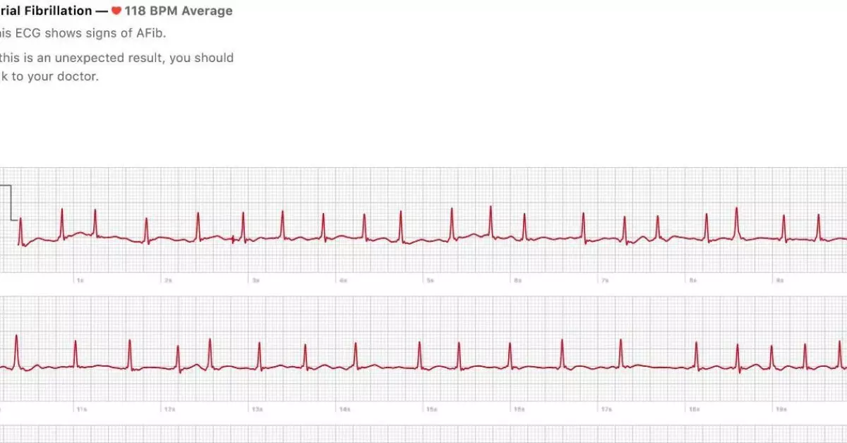 Un utilisateur d'Apple Watch découvre un problème cardiaque A-fib avec une nouvelle application ECG, "cela vous a probablement sauvé", déclare un médecin