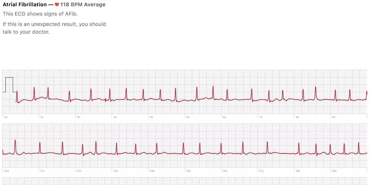 Apple Watch kullanıcısı yeni EKG uygulamasıyla A-fib kalp sorununu keşfetti, 